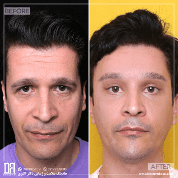 Forehead Contouring | Transform Your Look with Advanced Bone Reshaping